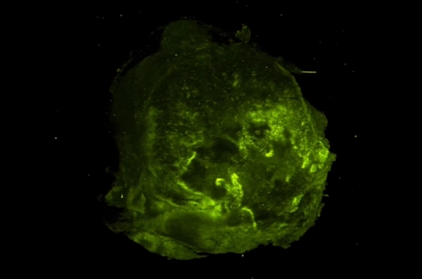 A realidade virtual no tratamento do câncer — Setor Saúde